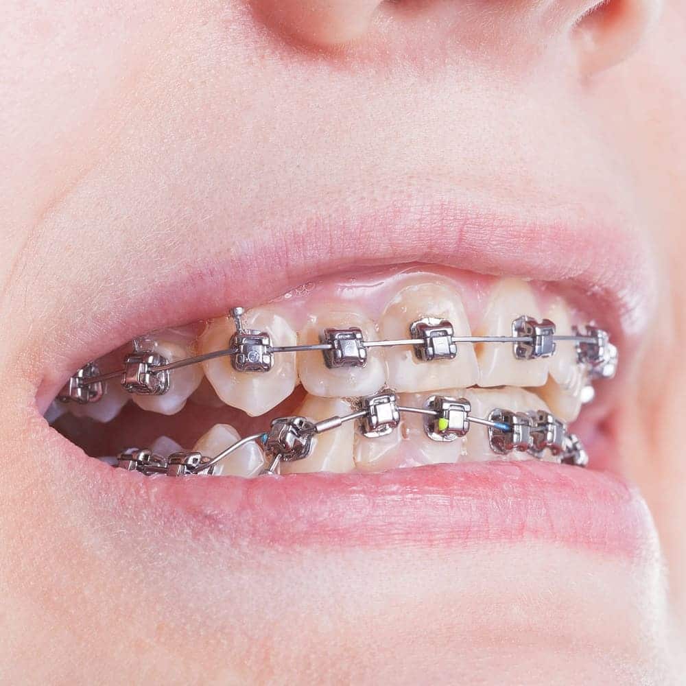Traditional Braces - Eisenberger & Bindiger Orthodontics